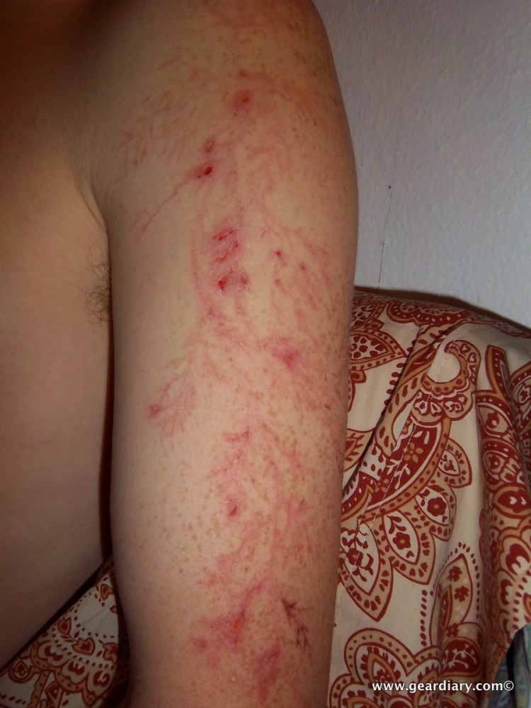 Meet Winston Kemp, Lightning Strike Survivor and Lichtenberg Figure Owner