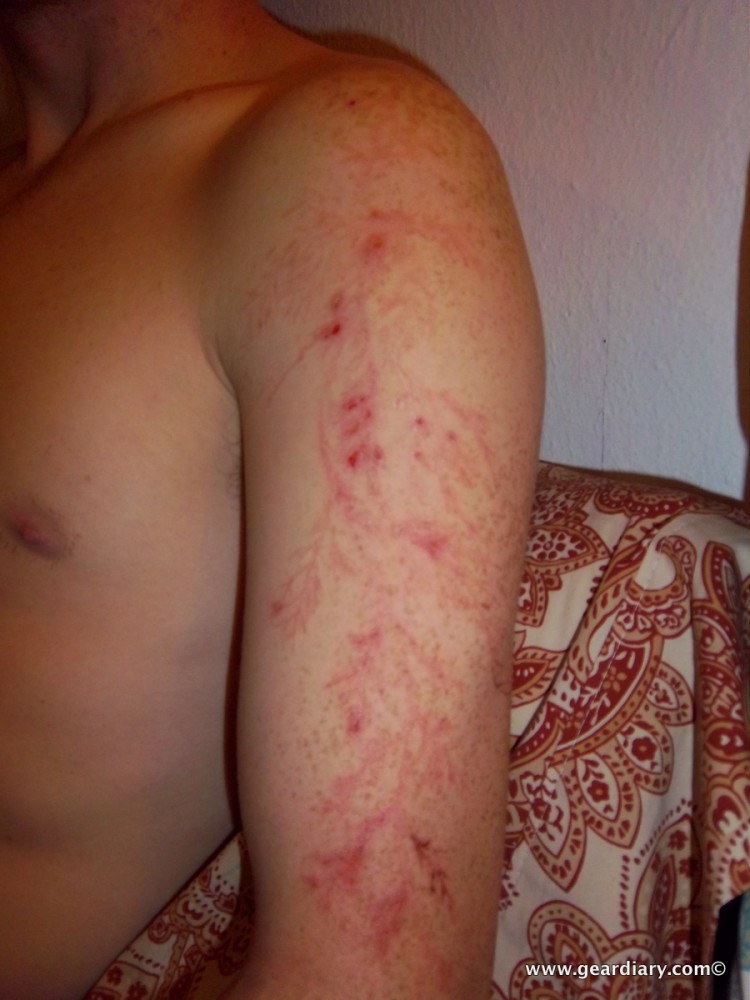 Meet Winston Kemp, Lightning Strike Survivor and Lichtenberg Figure Owner